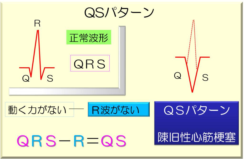 QRS-R=QS | 心電図新世界セミナー公式ブログ