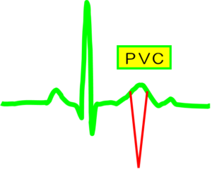 「RonT」で何かが起こる？ | 心電図新世界セミナー公式ブログ